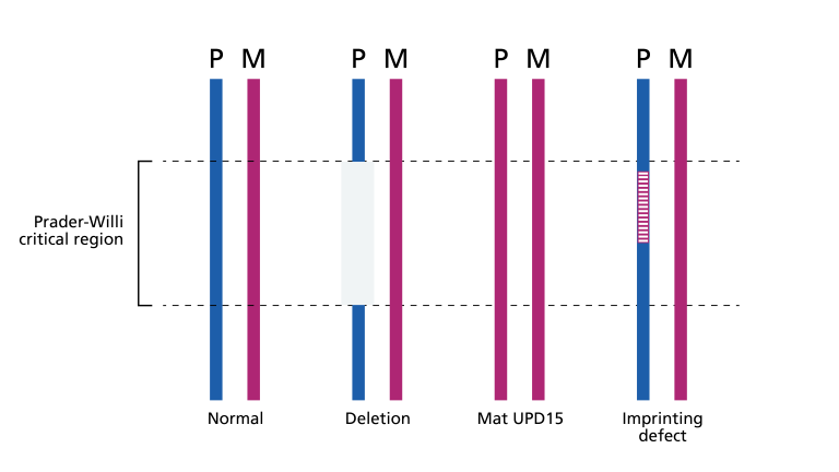 Prader-Willi syndrome — Knowledge Hub