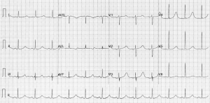 Long QT syndrome — Knowledge Hub