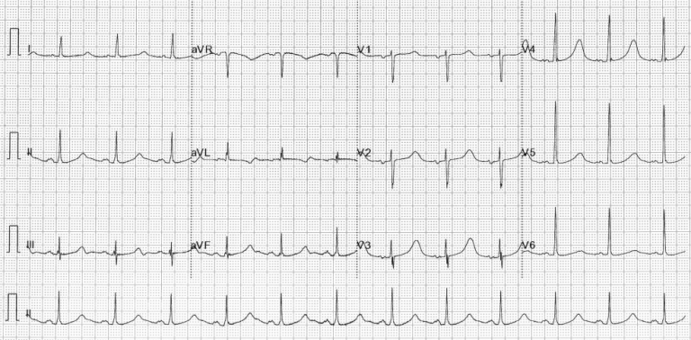 Long QT syndrome — Knowledge Hub