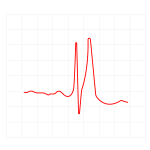 Short QT syndrome — Knowledge Hub