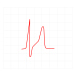 Short QT syndrome — Knowledge Hub