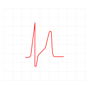 Short QT syndrome — Knowledge Hub