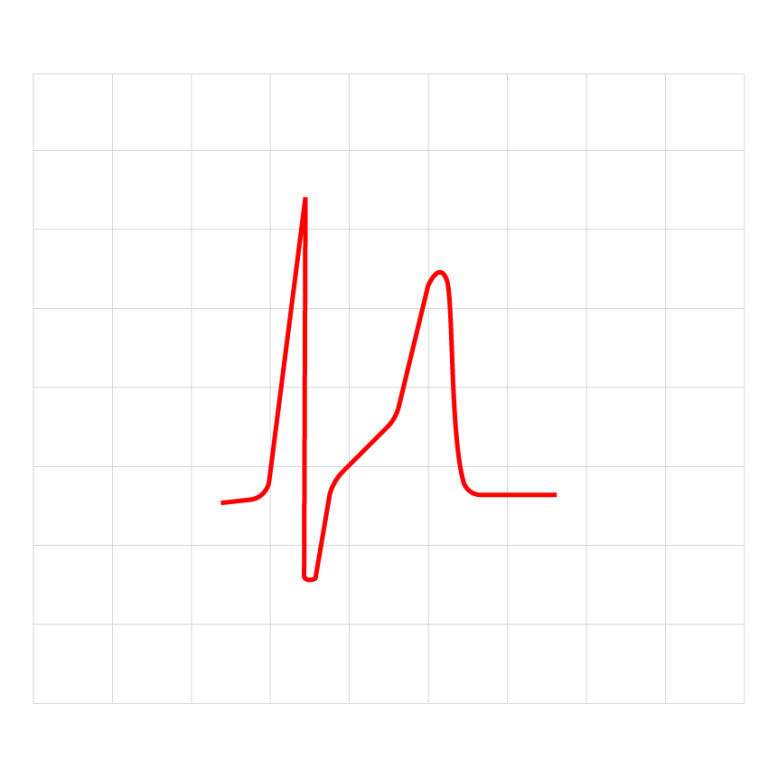 Short QT syndrome — Knowledge Hub
