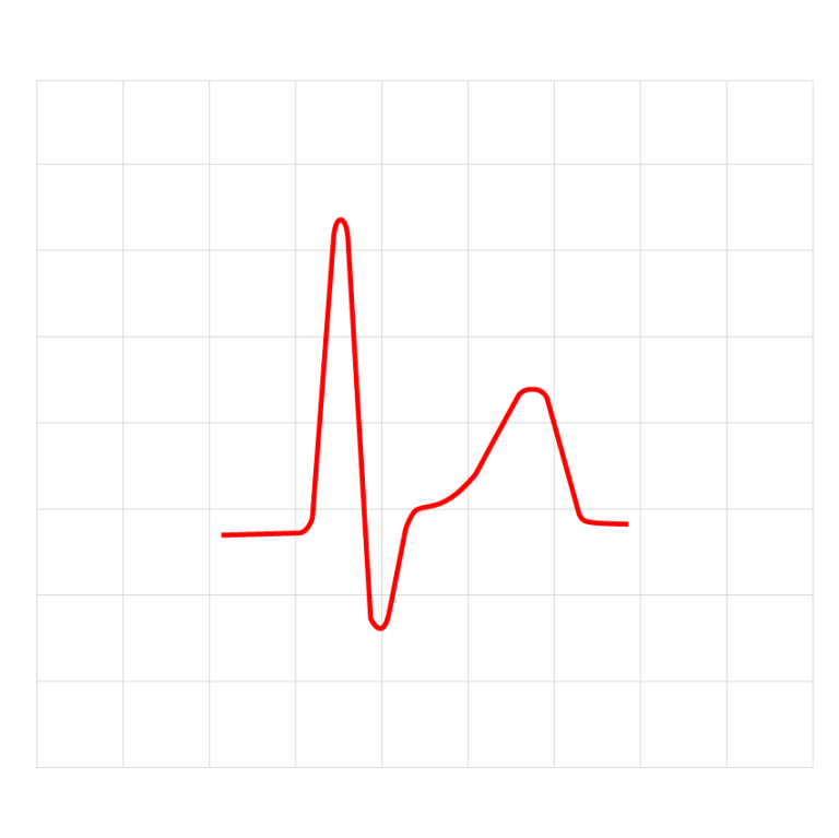 Short QT syndrome — Knowledge Hub