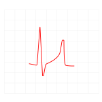 Short QT syndrome — Knowledge Hub