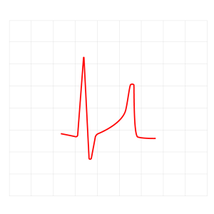 Short QT syndrome — Knowledge Hub