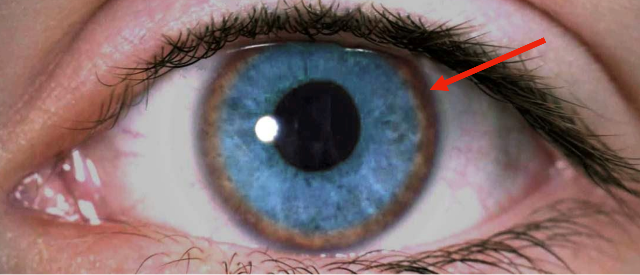 Wilson disease — Knowledge Hub