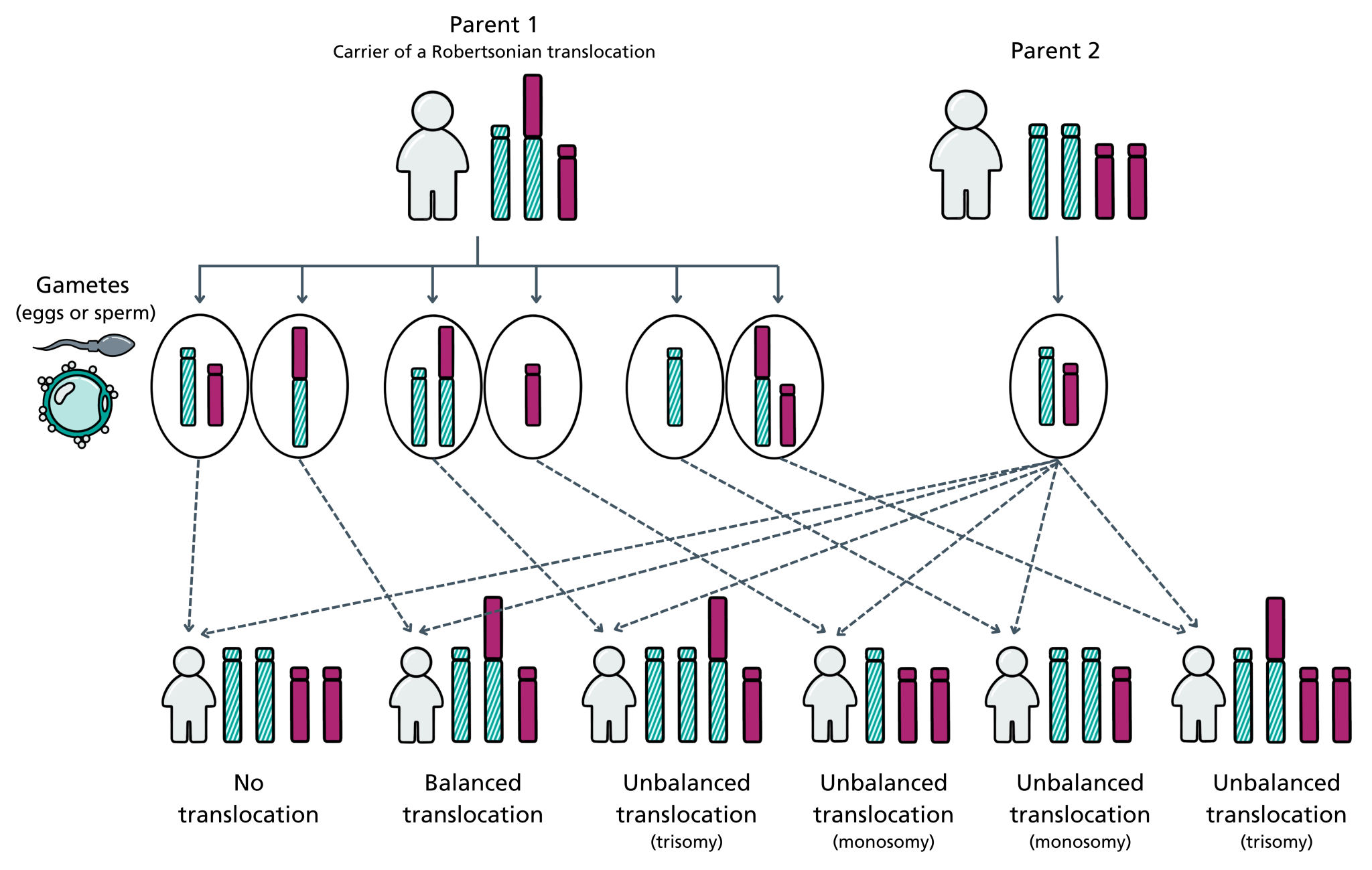 Visual communication aid: Robertsonian chromosome translocations — Knowledge Hub