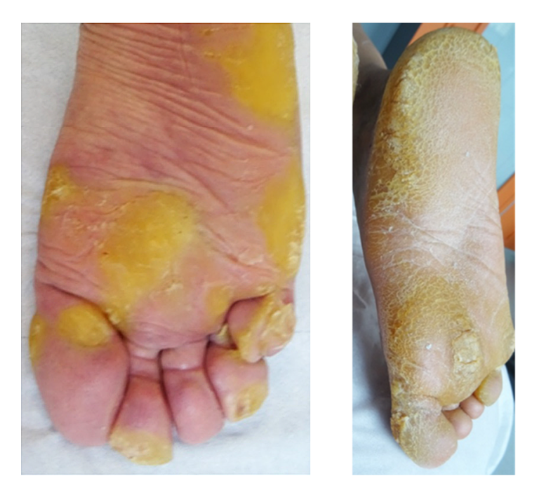 Palmoplantar epidermal differentiation disorders (palmoplantar ...